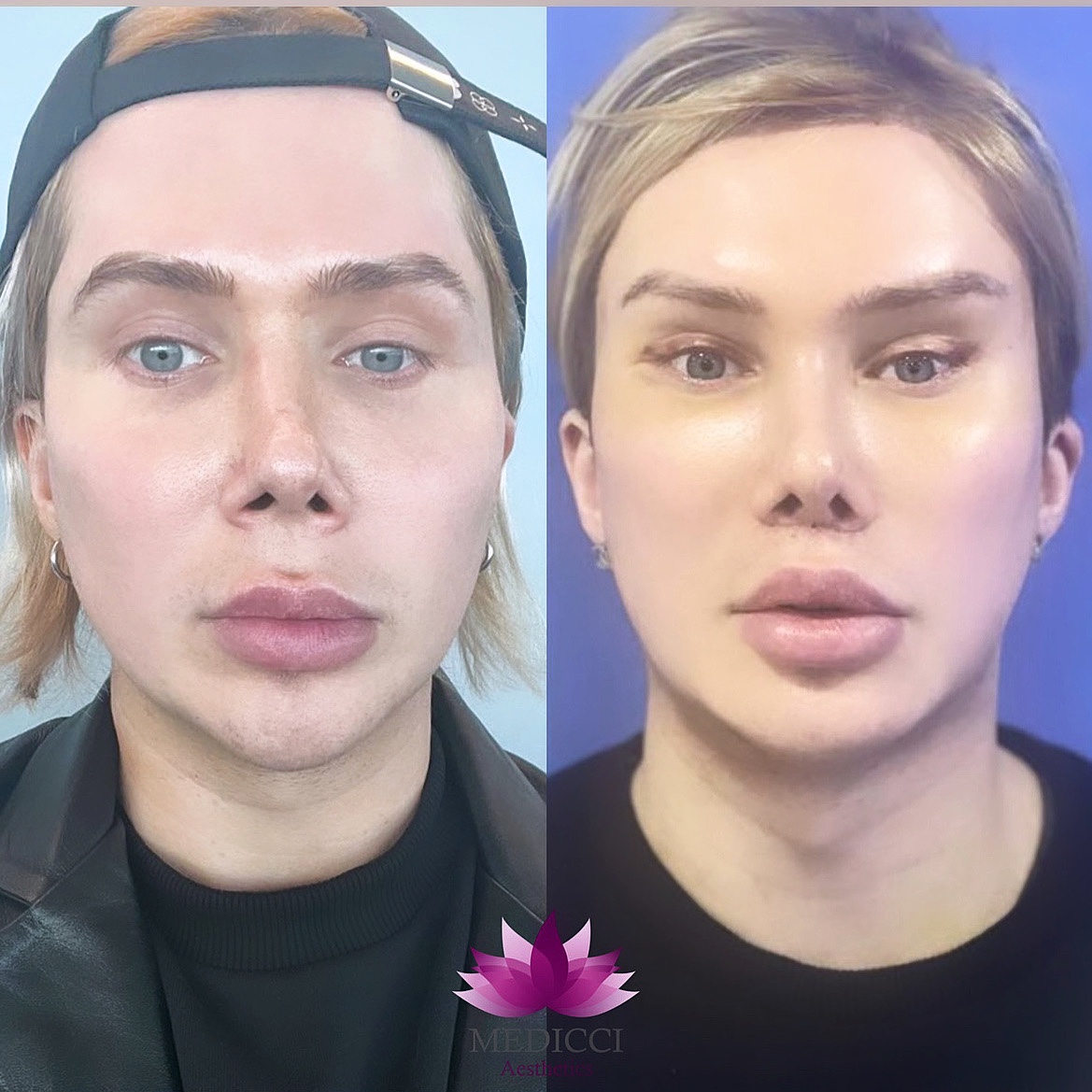 TikTok Star Oli London undergoes major cosmetic surgery makeover with ...